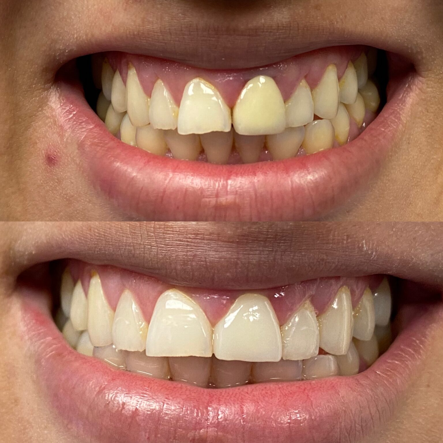 Dentistry Before and After Photos | EverSmile Dental